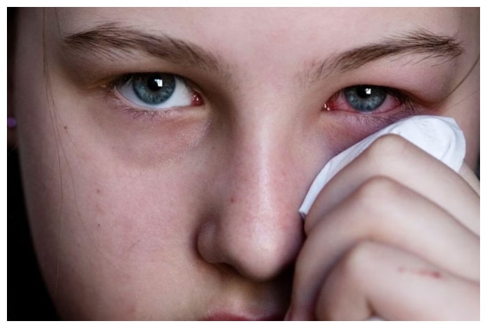 दिल्ली-NCR में तेजी से बढ़ रहे Eye Flu के मामले, जानें अचानक क्यों बढ़ने लगे केस