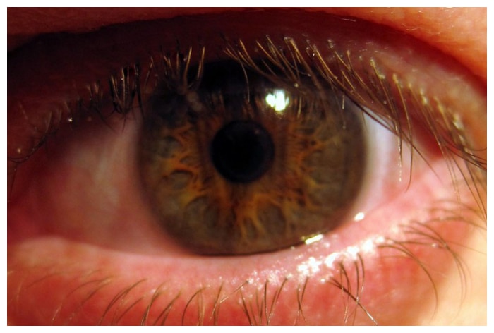 Delhi Sees Record Rise In Pink Eye, Dengue Cases, Say Doctors