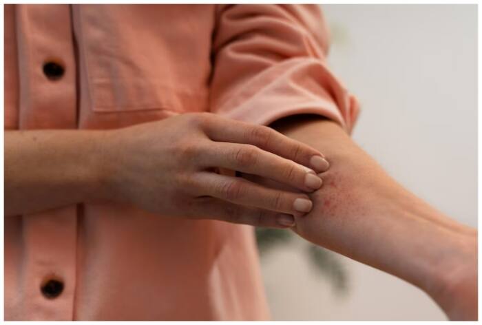 What is Scrub Typhus, Bacterial Infection Claiming Lives in Shimla ...