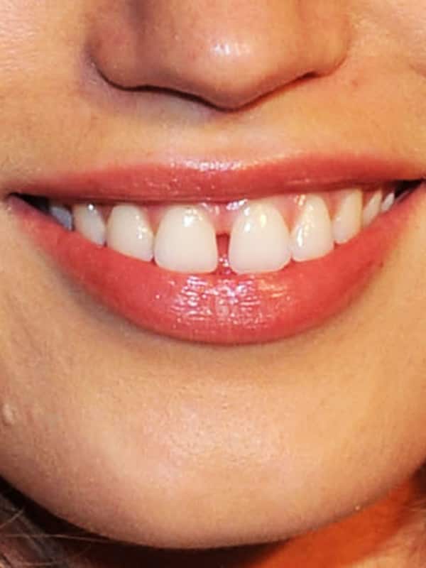 O que significa uma lacuna entre os dentes? 5 coisas que você precisa ...
