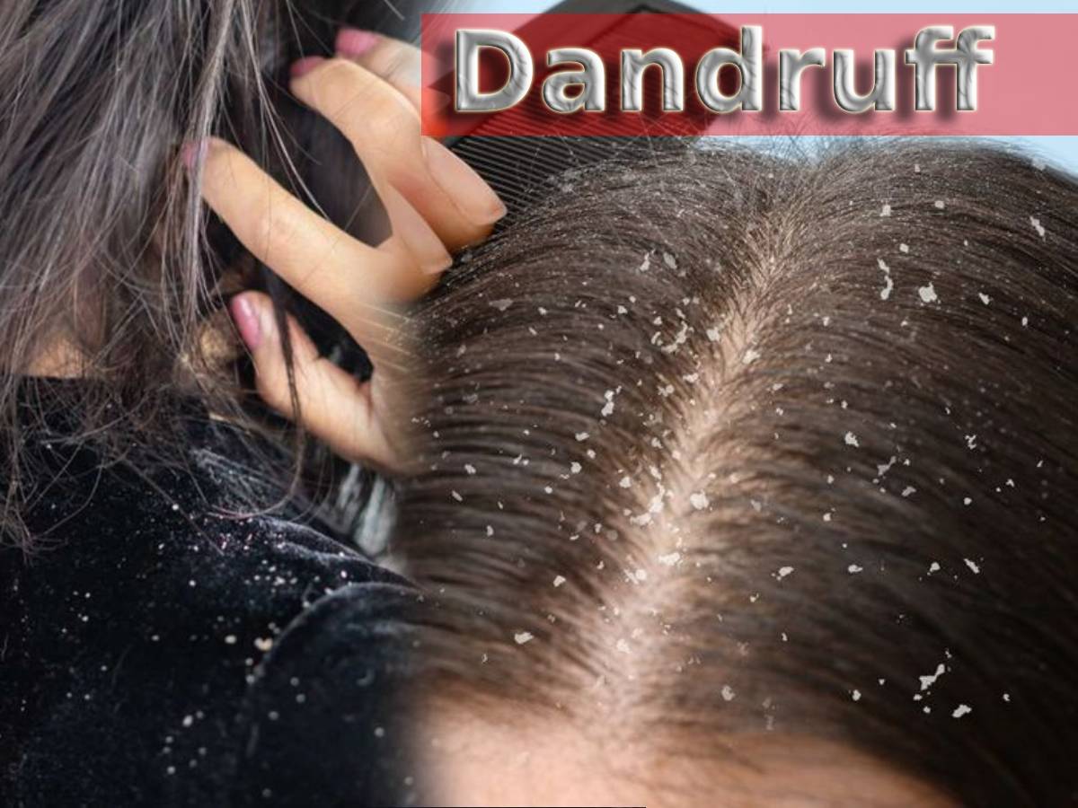 सर्दियो में क्यों होती है Dandruff की समस्या, ये हैं रूसी की 5 वजहें और ...