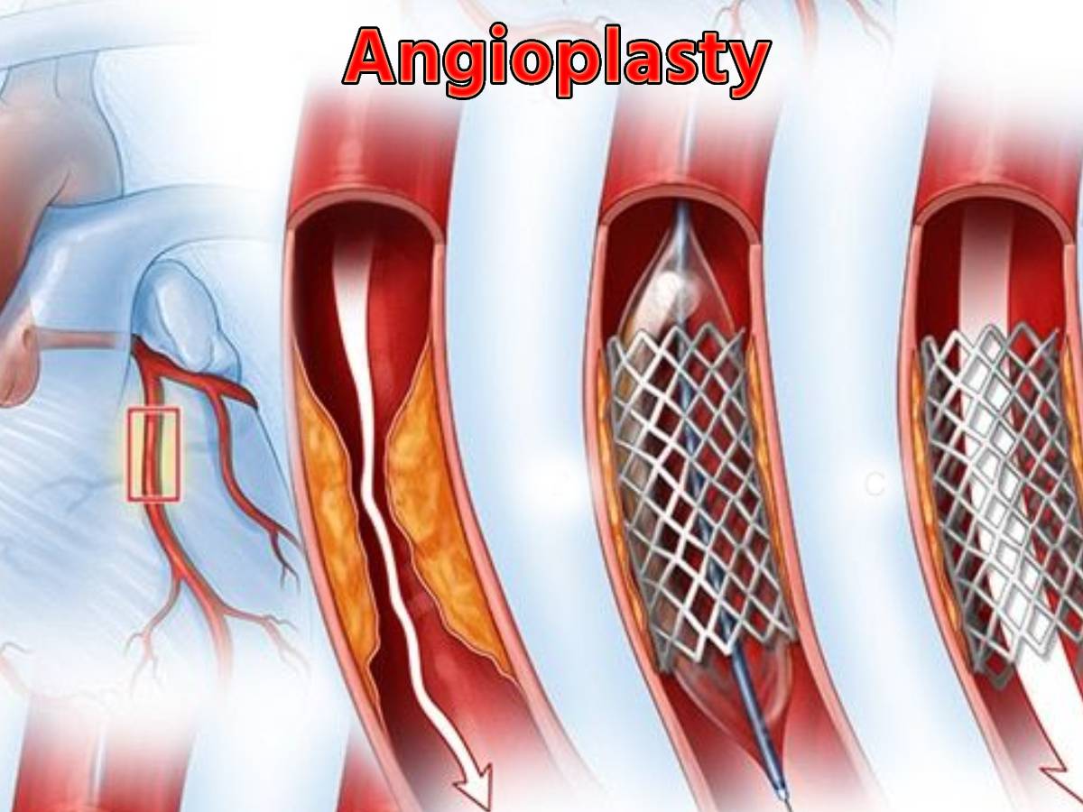 Angioplasty क्या होती है, किसे इसकी जरूरत होती है? और इसके फायदे भी जानिए