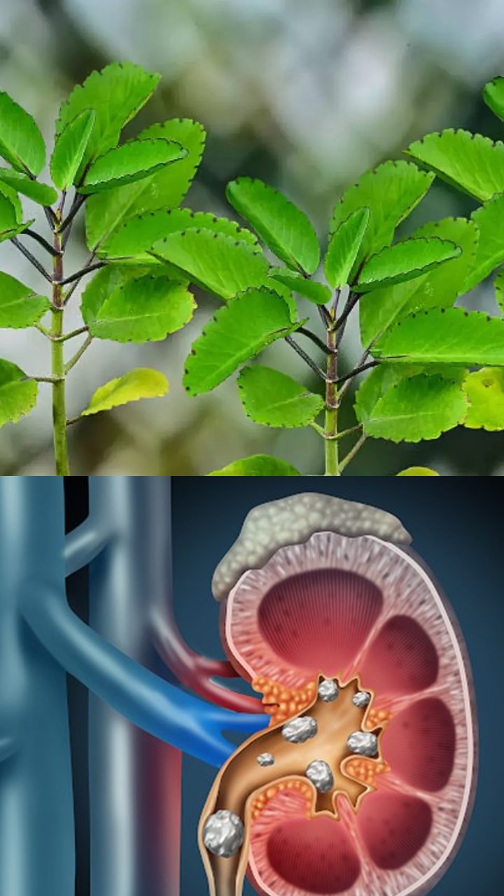 पत्थरचट्टा से पथरी कैसे निकलती है बाहार?