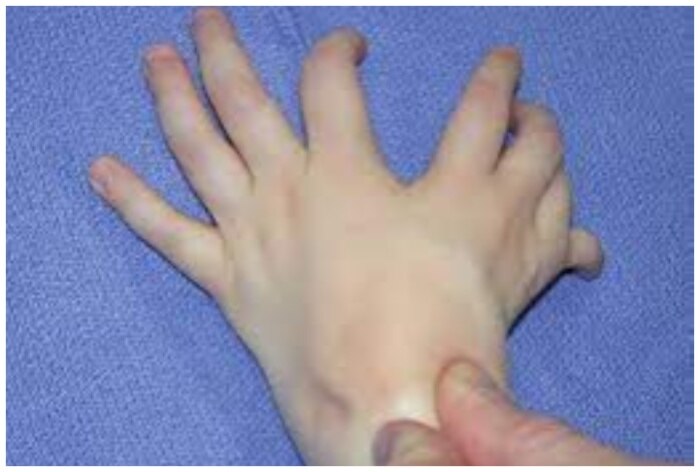 क्या है मिरर हैंड सिंड्रोम? डॉक्टर से जानें इसके लक्षण और उपचार