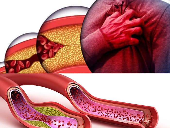 ये 5 संकेत बताते हैं शरीर में बढ़ गया है Cholesterol, समय रहते हो जाएं ...
