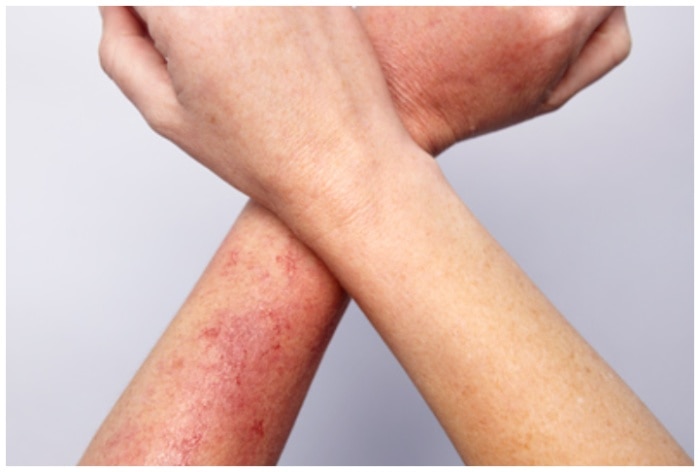 क्या है स्किन रोग फोटोडर्मेटाइटिस? डॉक्टर से समझें त्वचा को कैसे करता ...