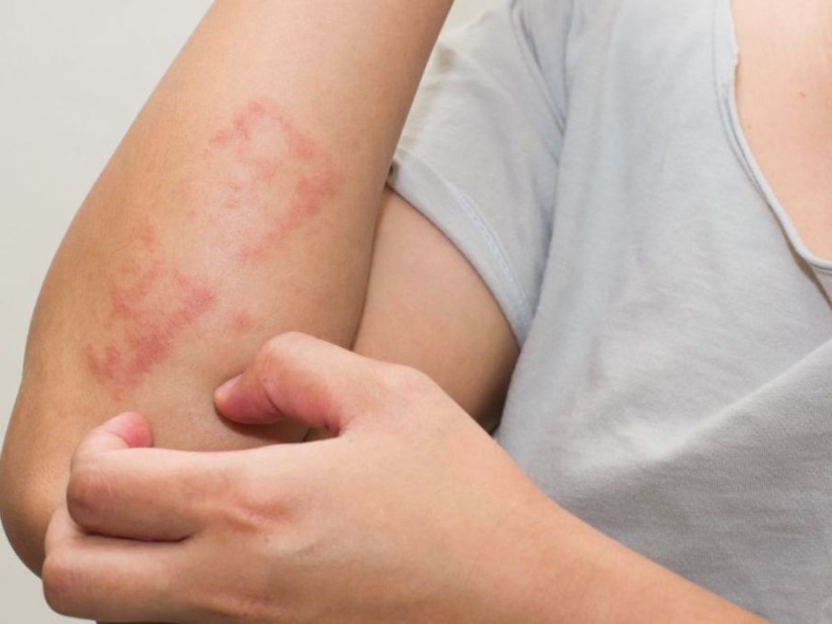 क्या है Dermatitis? जानें इसके लक्षण, कारण और बचाव के उपाय