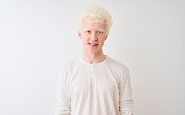 International Albinism Awareness Day 2024: Signs, Causes And Treatment ...