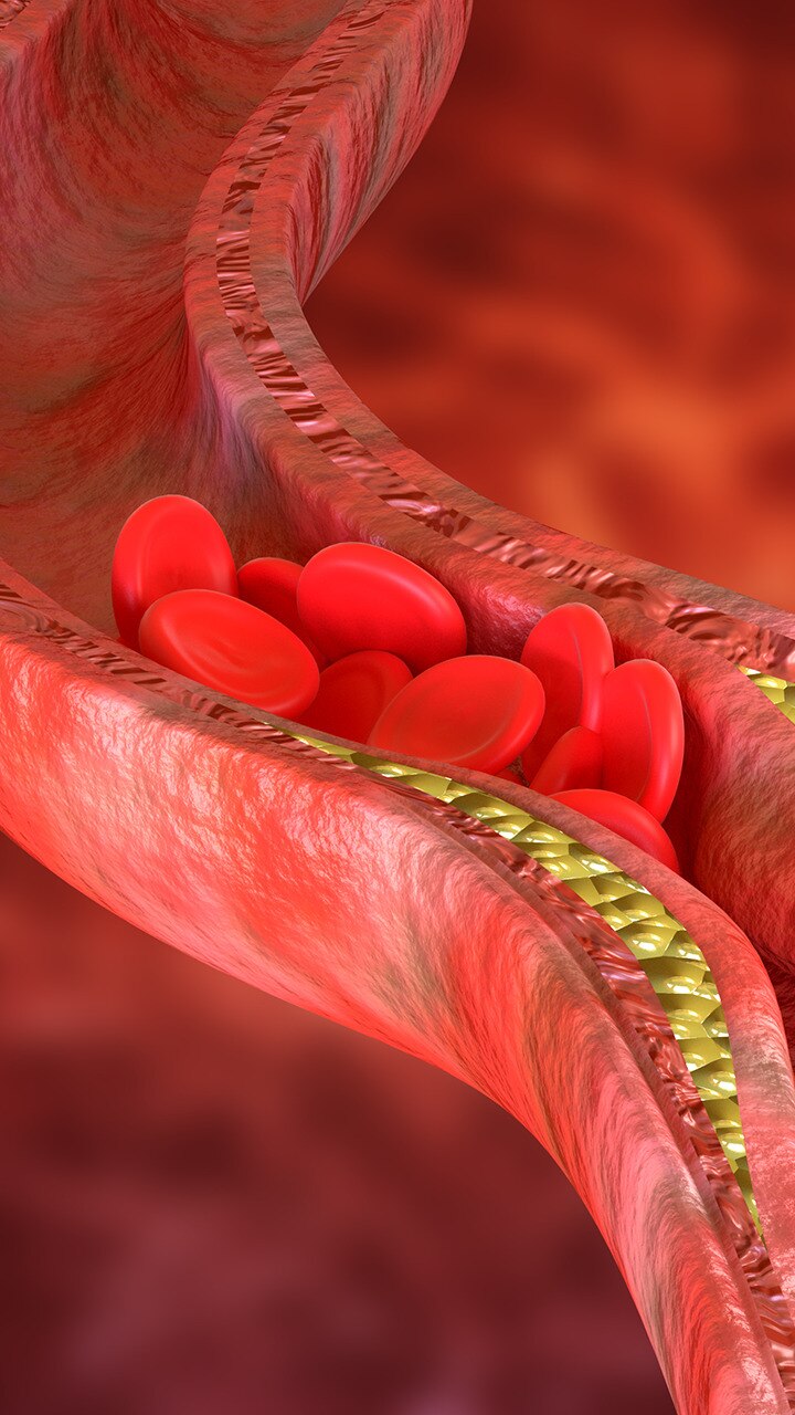 Cholesterol Treatment: 7 चीजें करें कभी नहीं होगा कोलेस्ट्रॉल, ब्लड ...