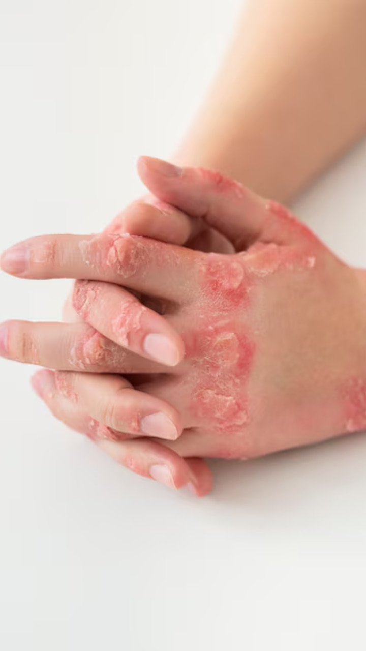 8 MUST Know Signs and Symptoms of Mpox