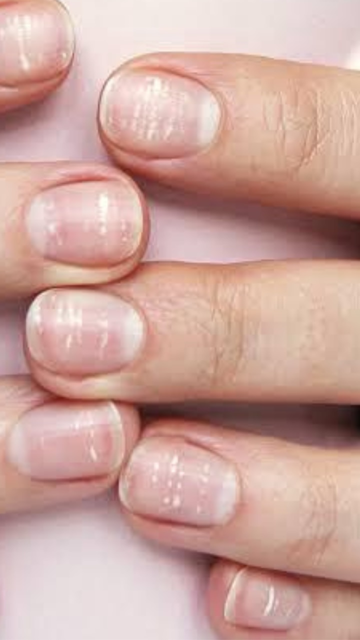 6 changes in your nails that indicate hidden diseases