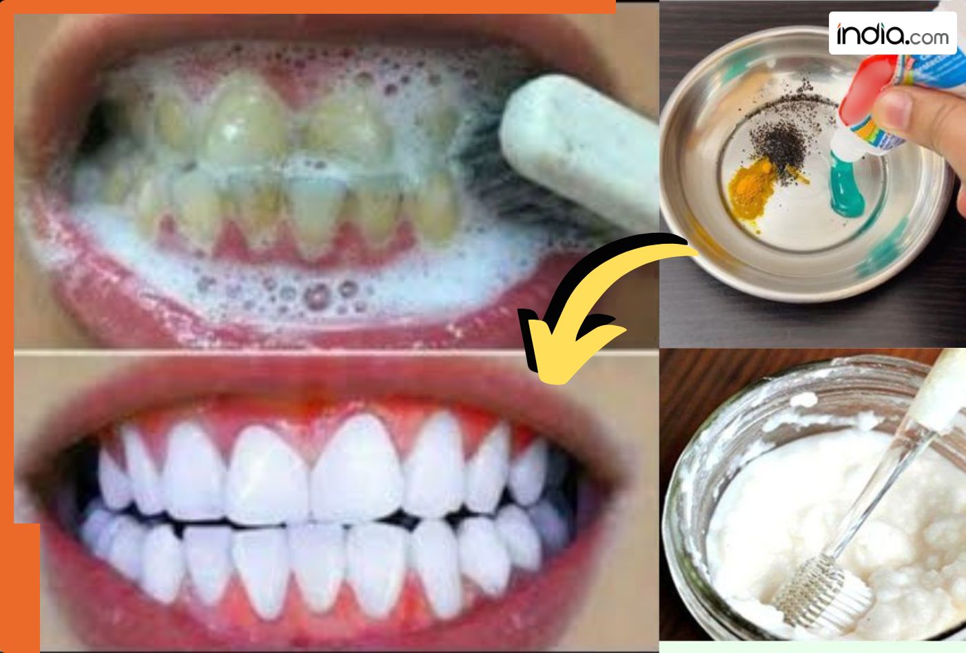 दांतों का पीलापन हटा सकता है ये चमत्कारी घरेलू नुस्खा....दूध जैसी सफेद चमकने लगेगी बत्तीसी