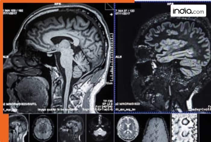 These rare brain disorders make you completely fearless; what are they ...