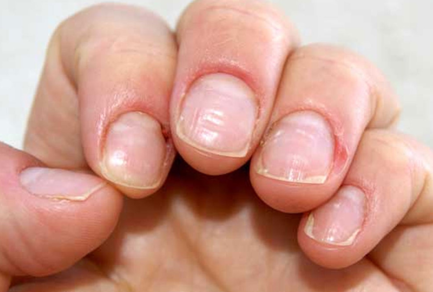 Weak Nails का मतलब हो सकता है शरीर के अंदर की गड़बड़ी! जानिए कैसे सही ...