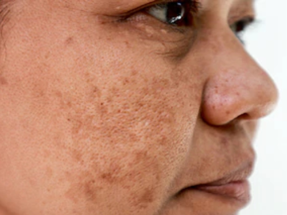coconut oil, alum, freckles removal